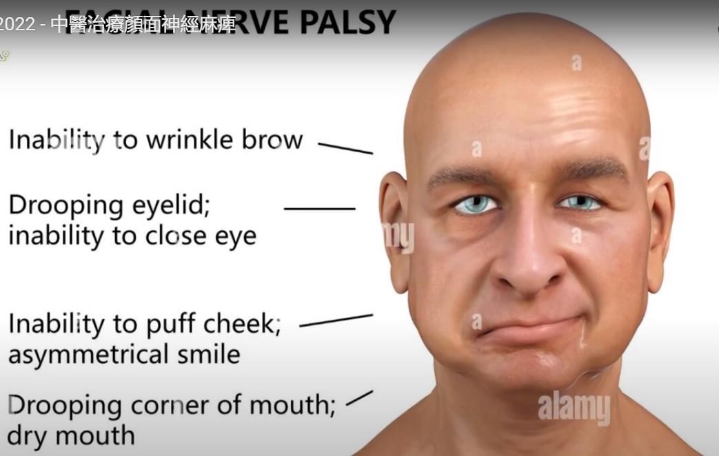 Traditional Chinese Medicine Acupuncture Treatment for Facial Paralysis ...